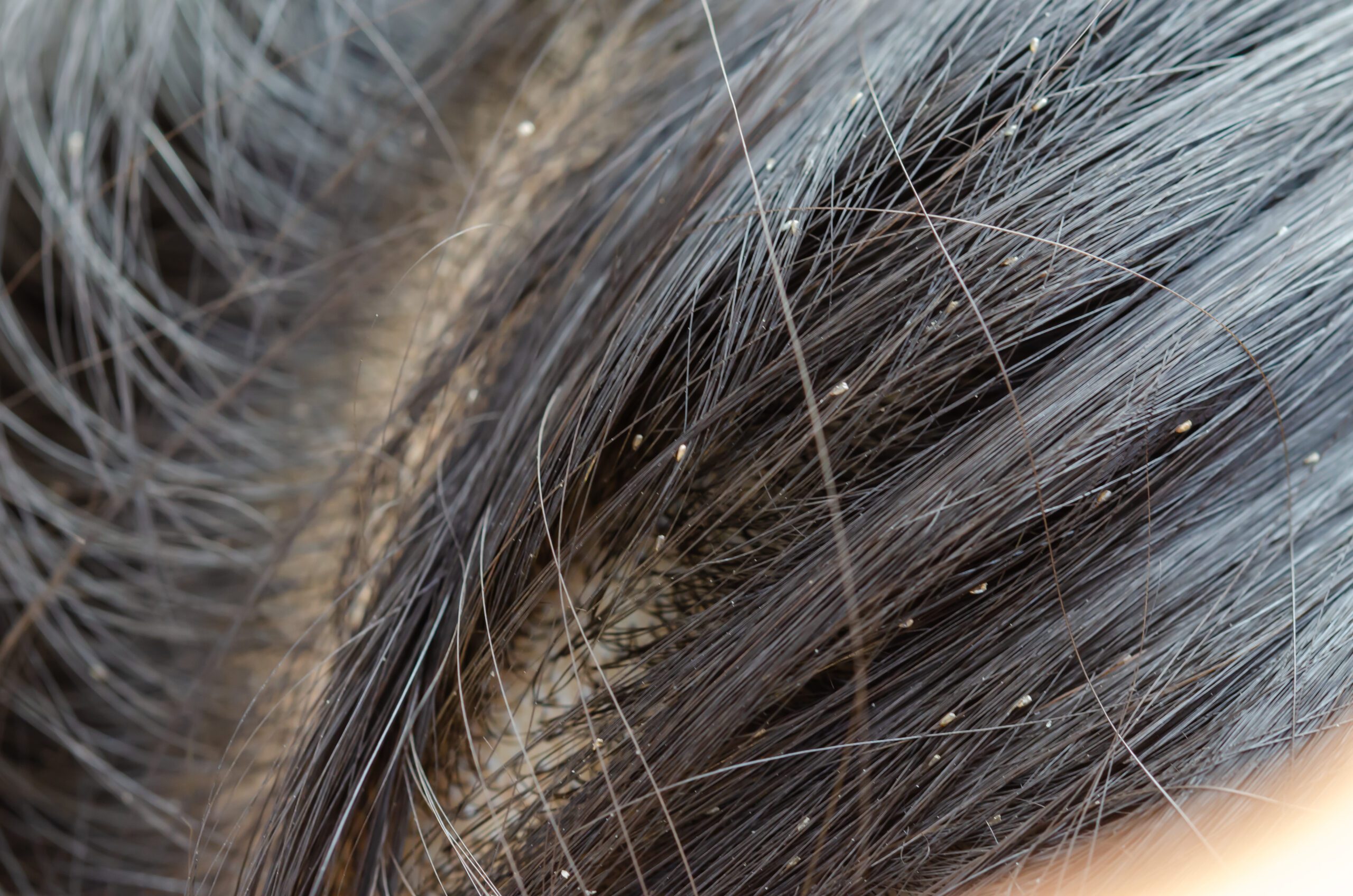 Ick! Head Lice - MedShadow Foundation | Independent Health & Wellness ...
