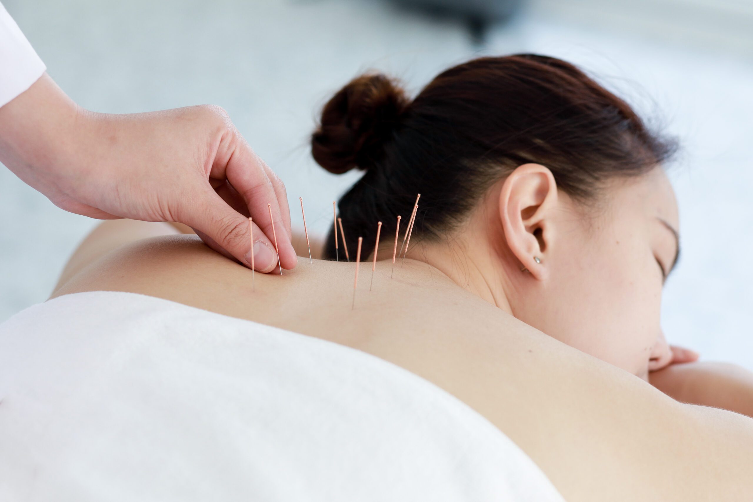 Acupuncture Can Help Alleviate Pain, Nausea, Insomnia and More ...