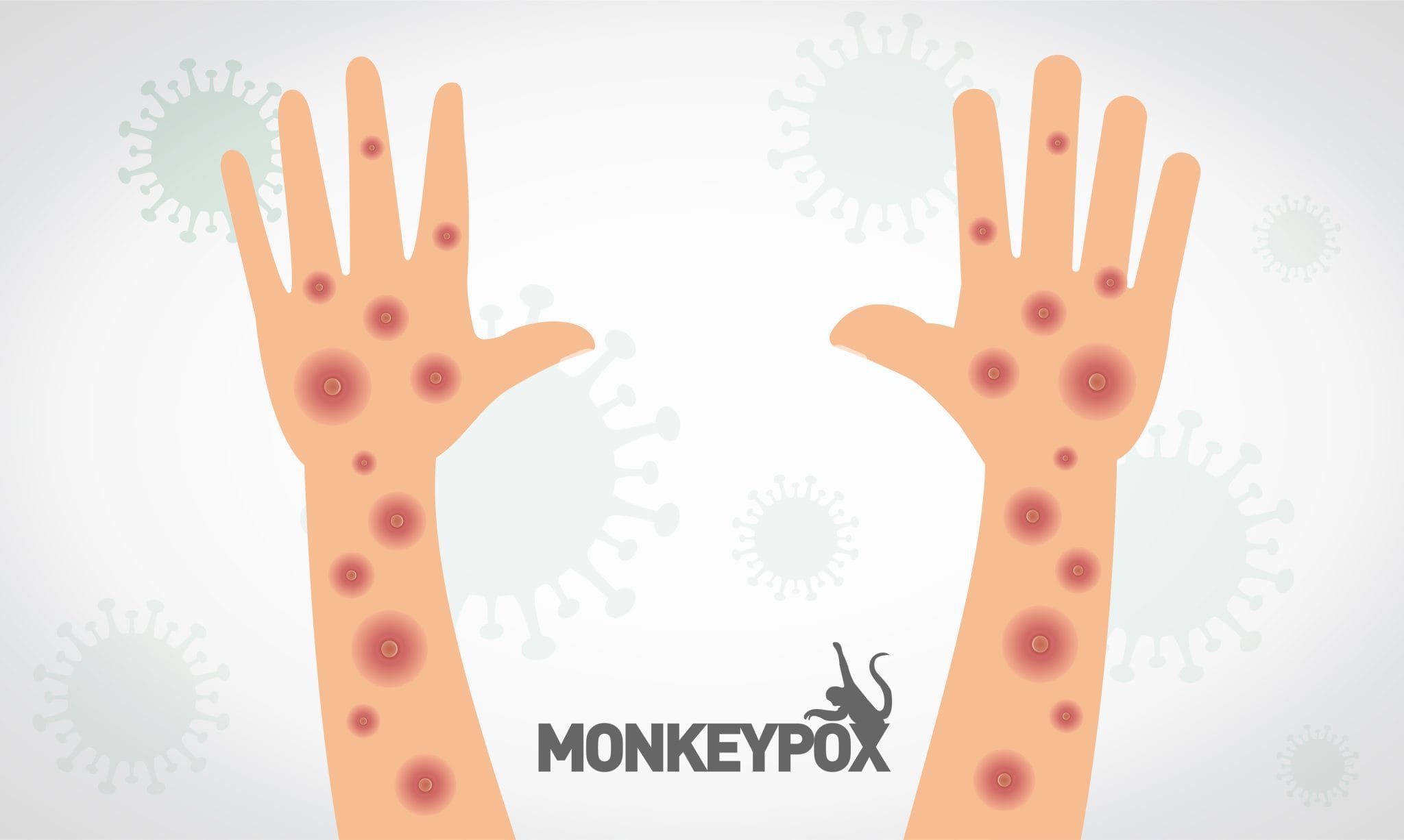 Frequently Asked Questions About the Monkeypox Outbreak - MedShadow ...
