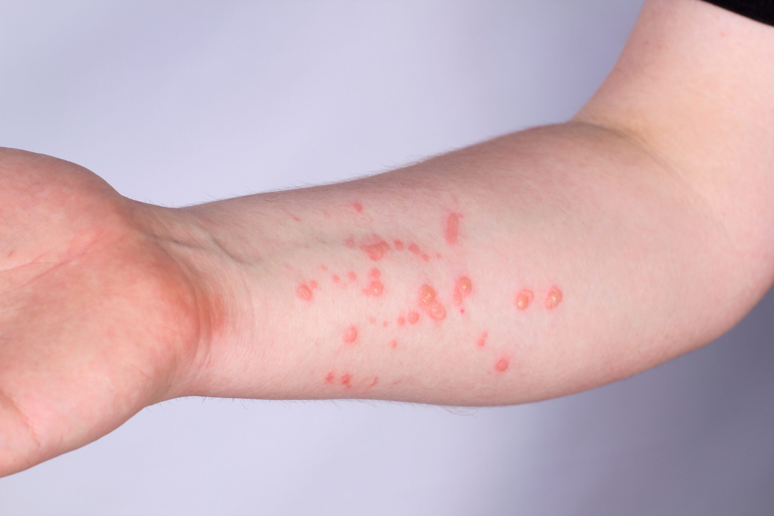 What To Know About Mpox - MedShadow Foundation | Independent Health ...